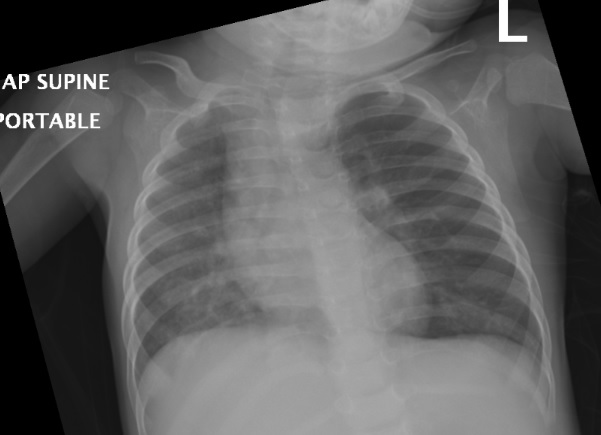 RLO: Growth Faltering in Children